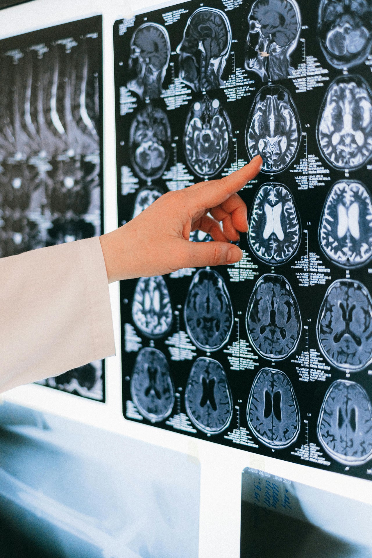 Can Homeopathy Help Heal the Brain? A Holistic Look at Concussion Reco ...
